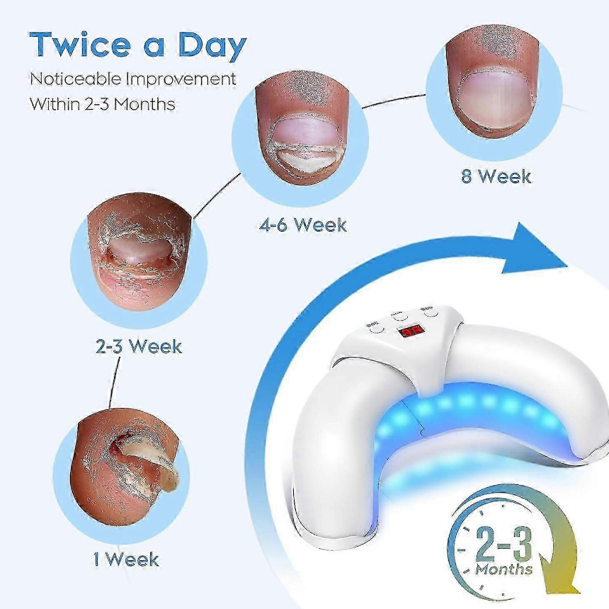 Foldable Nail Fungus Laser Treatment Device – Multi-Toenail & Fingerna ...